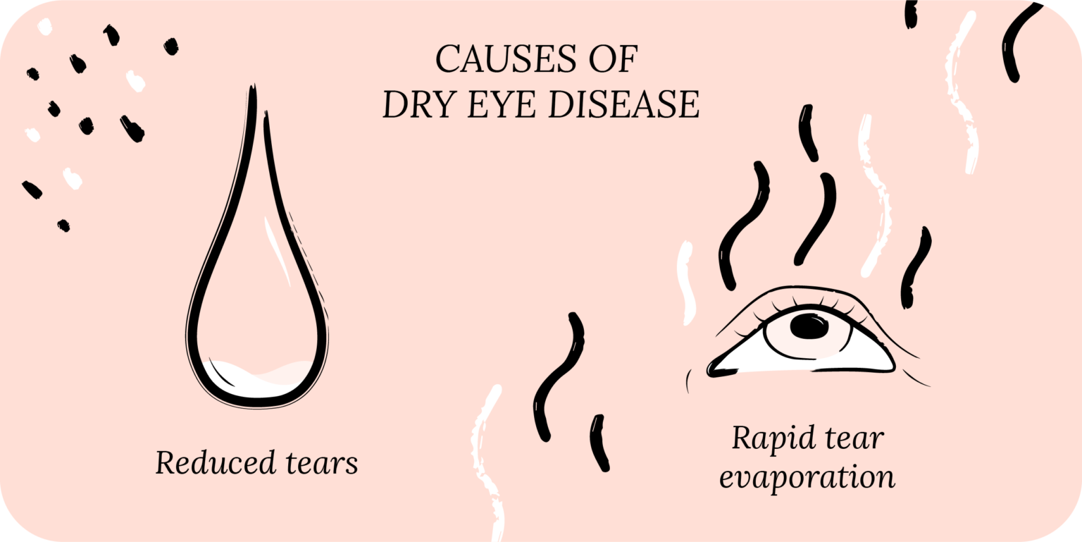 Different Types of Dry Eye Disease - CorneaCare