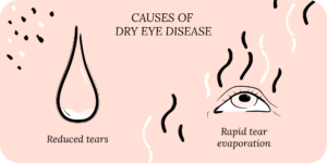 Different Types of Dry Eye Disease - CorneaCare