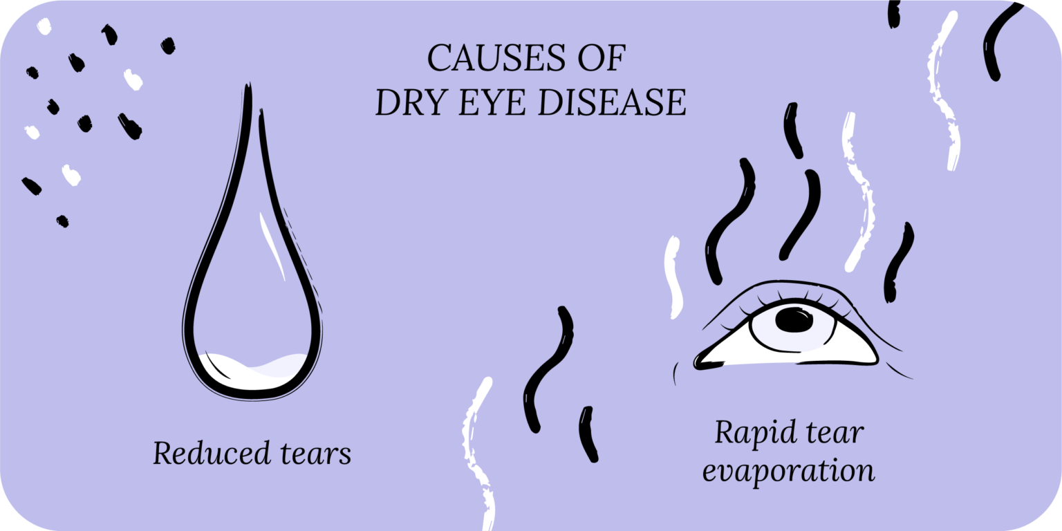 Dry Eye Treatment Costs - CorneaCare | Eyecare Made Easy